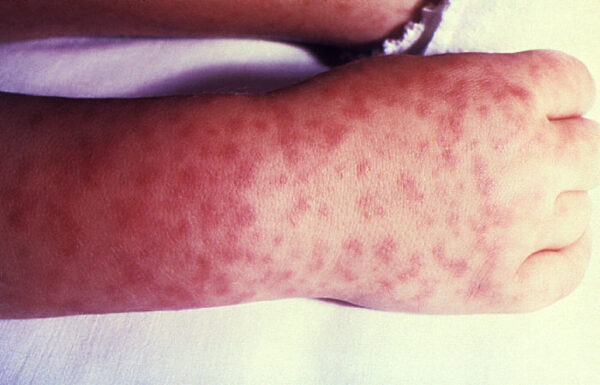 Rocky Mountain Spotted Fever: Symptoms, Treatment, and Prognosis - A-Z ...