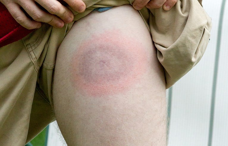 10 Facts You Likely Don't Know About Lyme Disease - A-Z Animals