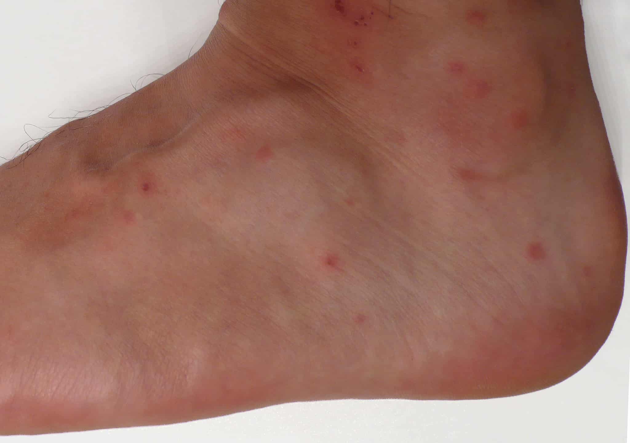 Clover Mites vs Chiggers: 4 Key Differences Between These Little Pests ...