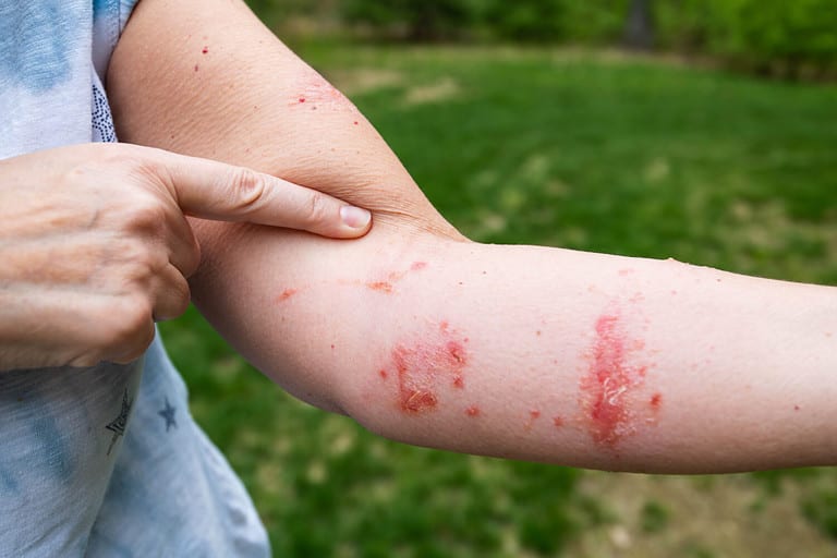 Poison Sumac vs Poison Ivy: Which One Is More Dangerous to Touch? - A-Z ...